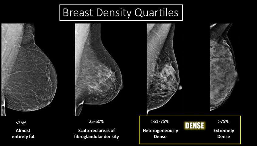 Breast Density’s Relationship to Cancer
