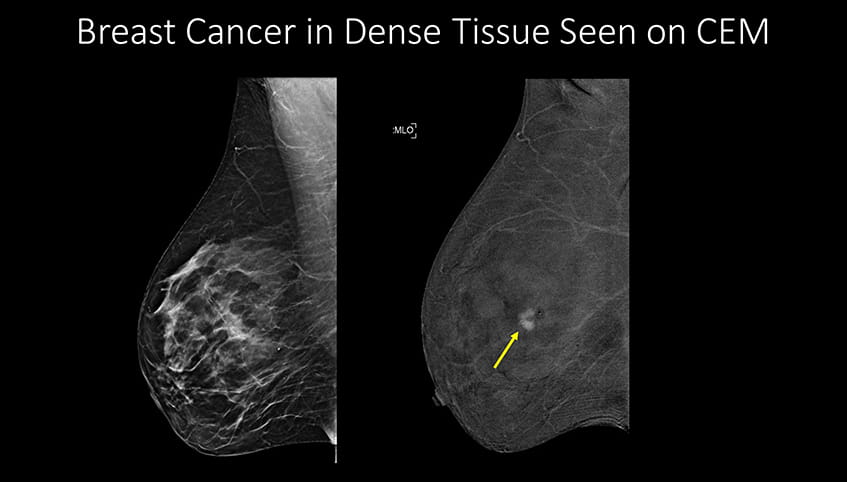 Breast Density’s Relationship to Cancer