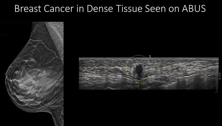Breast Density’s Relationship to Cancer