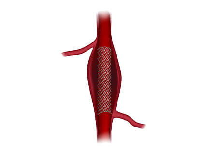 Stroke Signs & Treatments | The University of Kansas Health System